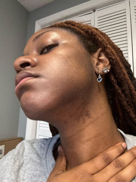 Hyperpigmentation On Neck Rblackskincare