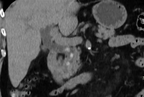 Choledocholithiasis Definition Symptoms Treatment