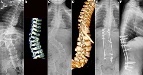 Multiple Hemivertebrae The Natural History And Treatment 57 Off