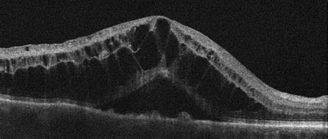 Macular Edema Oct
