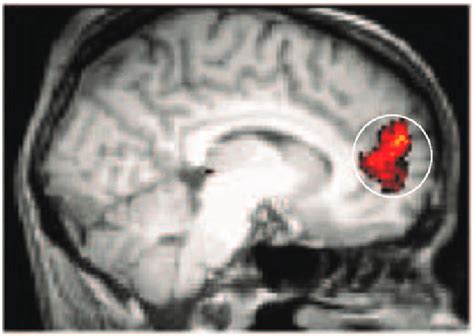 Higher Rostral Anterior Cingulate Racc Activation For Unpleasant Vs