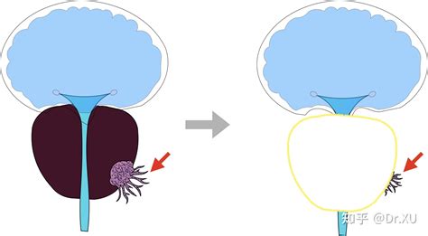 前列腺癌根治术后切缘阳性，要不要紧？ 知乎
