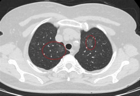 新冠感染后什么时候需要做肺部ct检查？ 知乎