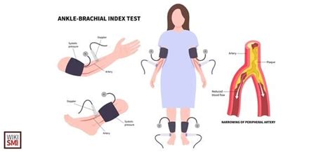 Ankle Brachial Index Abi Wikism Sports Medicine Wiki