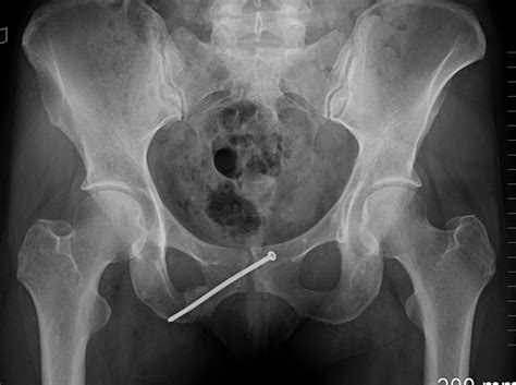 Hairline Fracture Hip Symptoms
