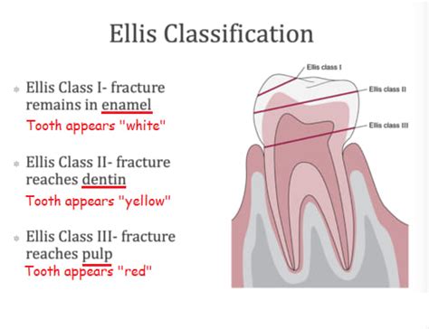 Medicine Keys For Internal Medicine Ellis Classification Of Tooth Fractures Dressing With