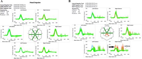 Video Head Impulse Test Vhit Representation A An Example Of Normal Download Scientific