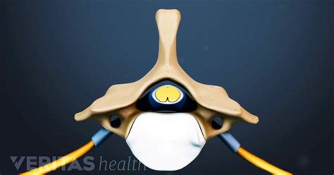 Overall Treatment Considerations For Lumbar Spinal Stenosis Artofit