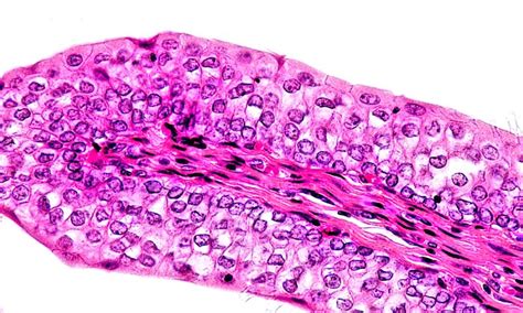 Arrayit Bladder Human Tissue Microarray 66 Cases And 80 Cores