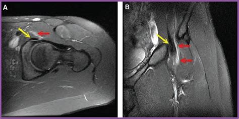 Snapping Hip Musculoskeletal Key
