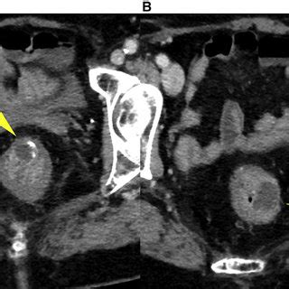 A Colonoscopy Showing Severe Edematous Erythematous Mucosa With