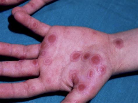 ERITEMA MULTIFORME Quizlet