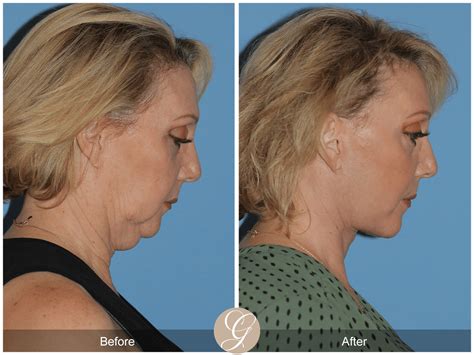 How Long Does Recovery Take For A Deep Plane Facelift Gallery Of