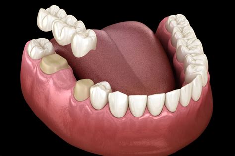 5 Common Types Of Dental Restorations Dental Specialties Northwest