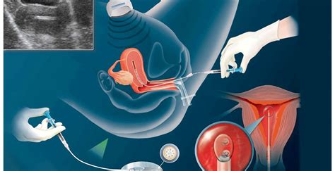 27 Facts About Insemination