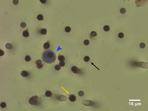 Circulating Tumour Cell Ctc Detected By Immunocytochemical