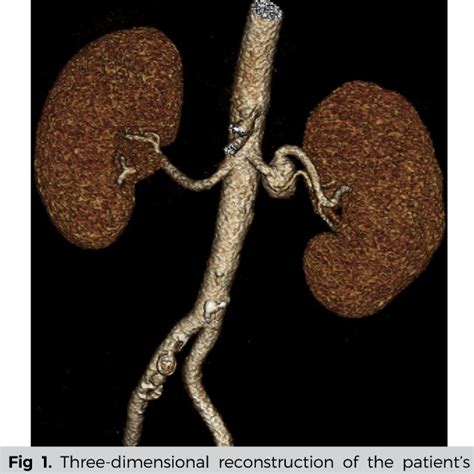 Figure 1 From Renal Artery Aneurysm Associated With Leber Hereditary