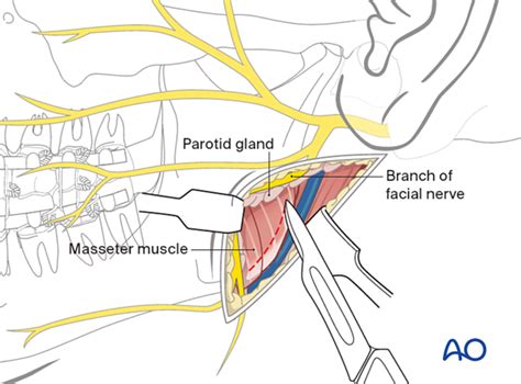 Retromandibular Approaches