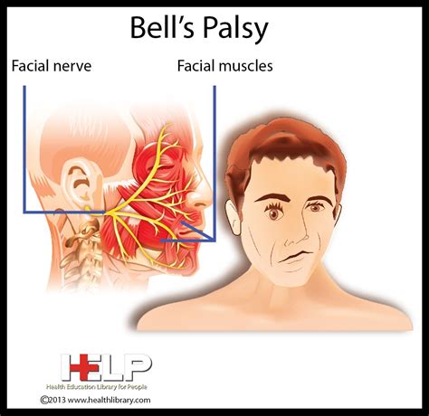 Best 13 Facial Palsy Aka Bells Palsy Or Facial Paralysis Artofit