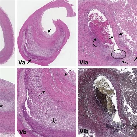 Histologic Examples Of Aha Plaque Types Ivvi Stained With Hande