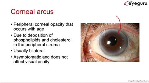 Corneal Arcus
