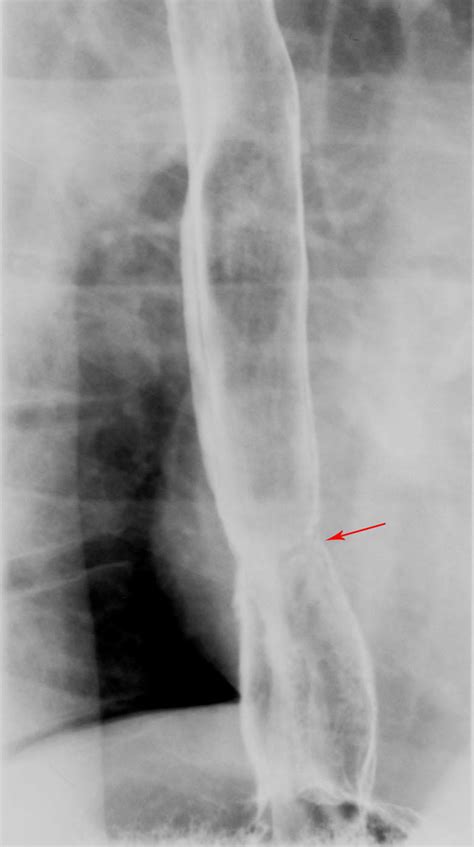 Scleroderma Esophagus