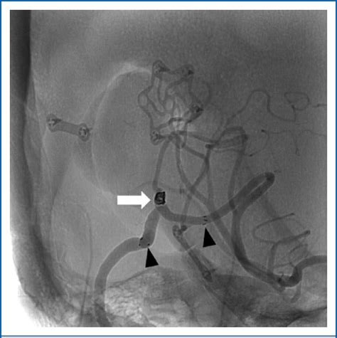 Control Angiogram Demonstrates Coils White Arrow Inside The Aneurysm Download Scientific