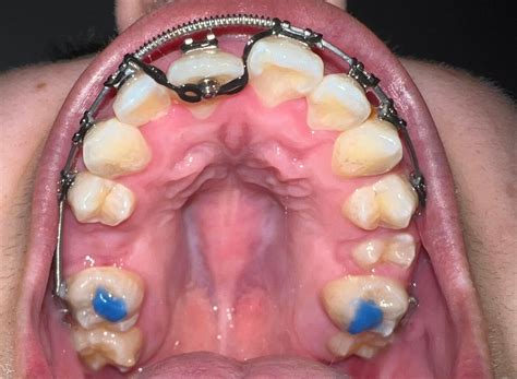 Fun Progress Pics First Is Oct 18th 2nd Is Nov 3rd And Last Is Today Nov 14th Cant Wait