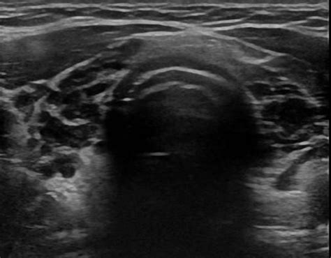 Head And Neck Thyroid Gland Case Thyroiditis And Diffuse Thyroid Disease