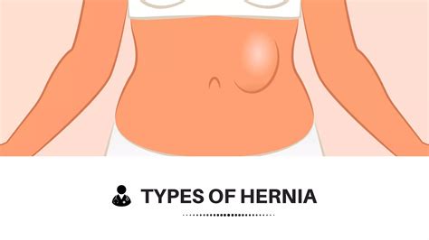 Types Of Hernia PDF Pregnancy Reproductive Health