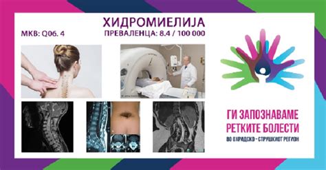 Ги запознаваме ретките болести Хидромиелија