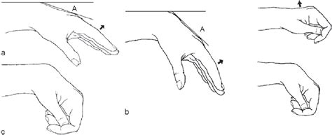 Figure 31 From Effects Of Botulinum Toxin A Injections And Bimanual