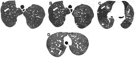 Imaging Of Small Airways And Emphysema Clinics In Chest Medicine