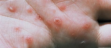 Etapa Temprana De La Sífilis En Las Mujeres