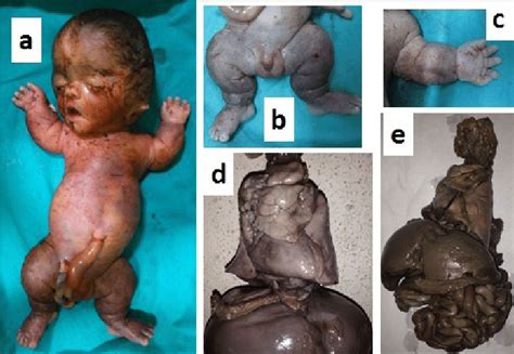 A Comparatively Large Head With Frontal Bossing Protuberant Abdomen