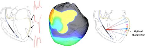 Automated Detection Of Cardiac Arrhythmia Locations To Optimise