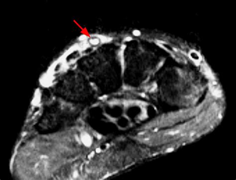 Stenosing Tenosynovitis Of The 4th Extensor Compartment Radsource
