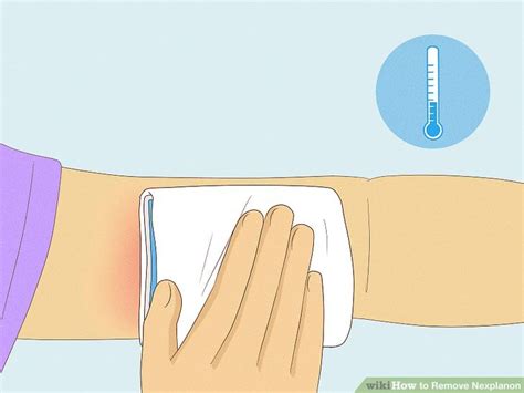 How To Remove Nexplanon Where To Get It Removed More
