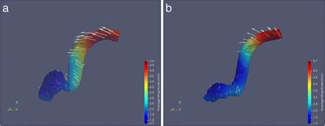 Morphological Analysis Of Sigmoid Sinus Anatomy Clinical Applications