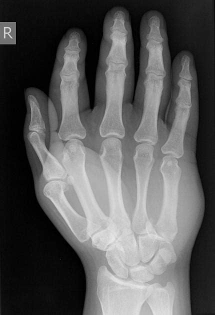 Metacarpal Shaft Fracture