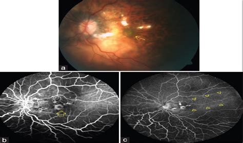 Concurrent Management Of Myopic Choroidal Neovascularization Indian Journal Of Ophthalmology