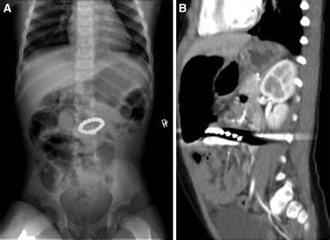 The Great Escape The Surprising Finding In A Case Of Acute Vomiting