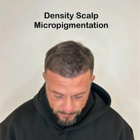 Density Scalp Micropigmentation The Ultimate Solution For Thicker Looking Hair