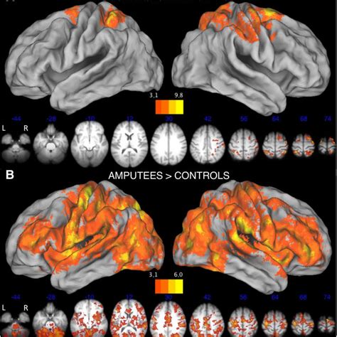 Differences In Neural Activity Between Groups Associated With Pdt Task Download Scientific
