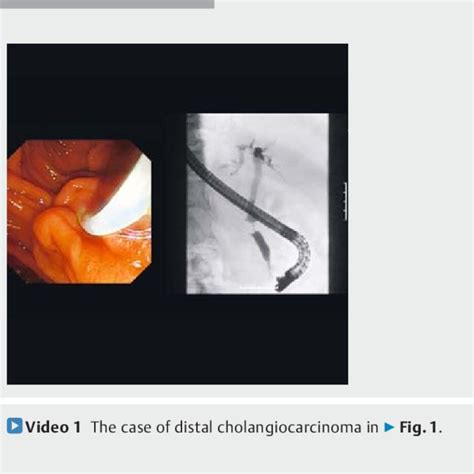 Pdf Usefulness Of Cholangioscopic Guided Mapping Biopsy Using Spyglass Ds For Preoperative