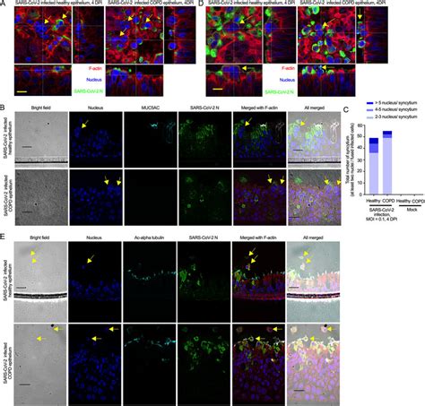 Sars Cov 2 Induces Syncytia And Cell Sloughing A The Airway