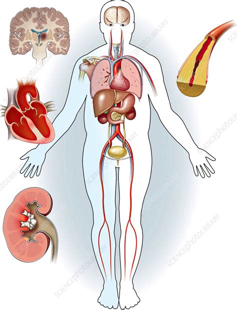 Embolic Infarcts Illustration Stock Image C059 3369 Science Photo Library