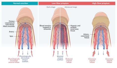 Medication Induced Priapism