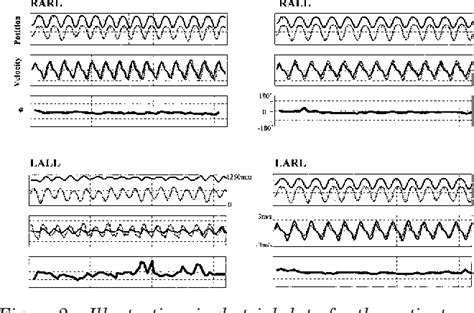Figure 1 From Interlimb Coordination Deficits During Cyclic Movements
