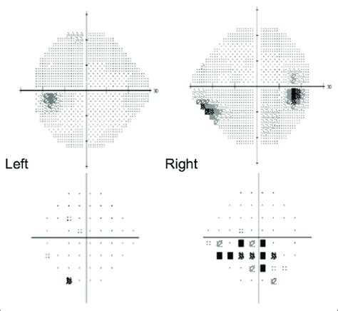 Humphrey Visual Fields Of The Same Patient In Fig 1 Demonstrating Download Scientific Diagram